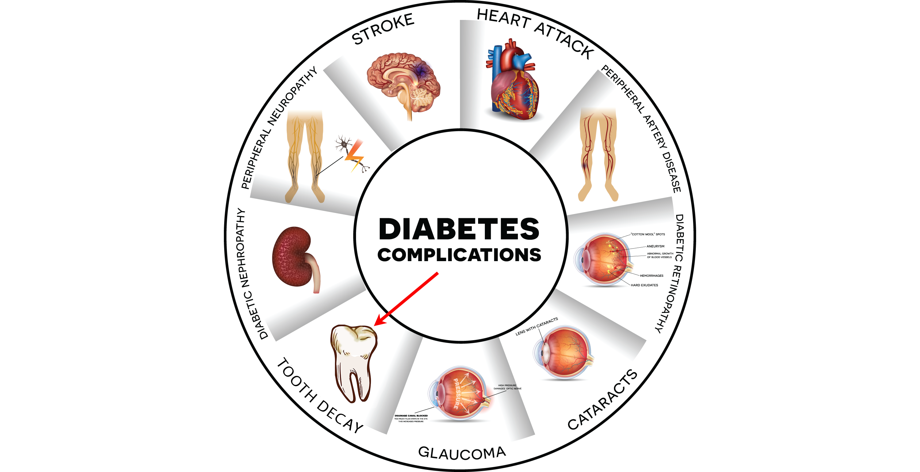 Hillcrest Family Dentistry Diabetes And Tooth Decay Hillcrest Family Dentistry Diabetes And Tooth Decay